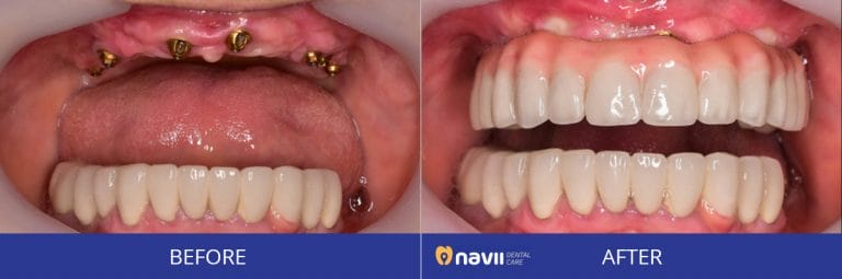 All-On-4 Implant | Navii Dental Care | The Biggest Dental Center In ...