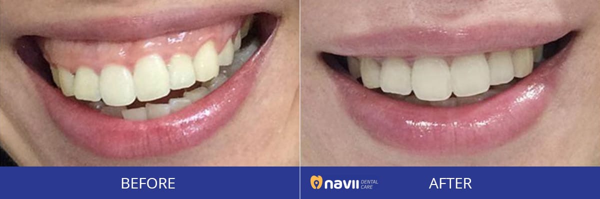 Gum Contouring Surgery – Navii Dental Care